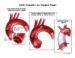 Aortic Dissection Surgery